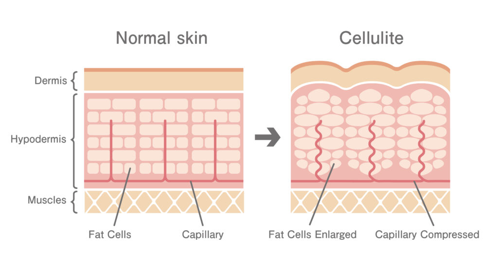 Cellulite – Dr. A Clinic